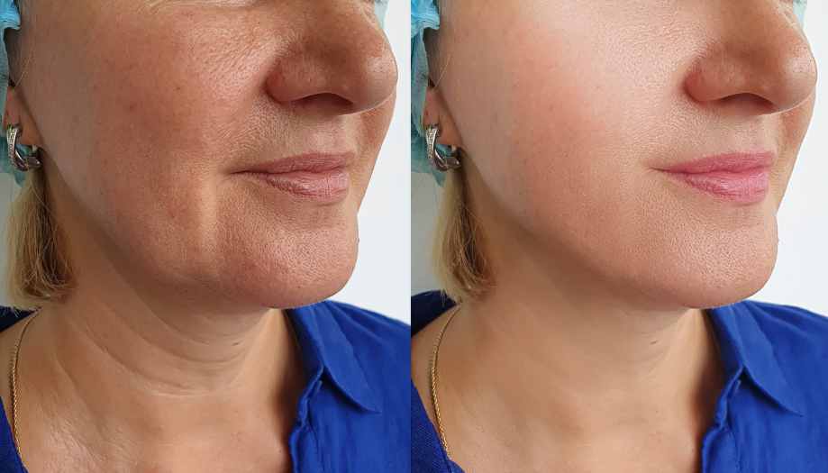 BENEFITS OF CO2 LASER FACIAL RESURFACING - Code for Miami